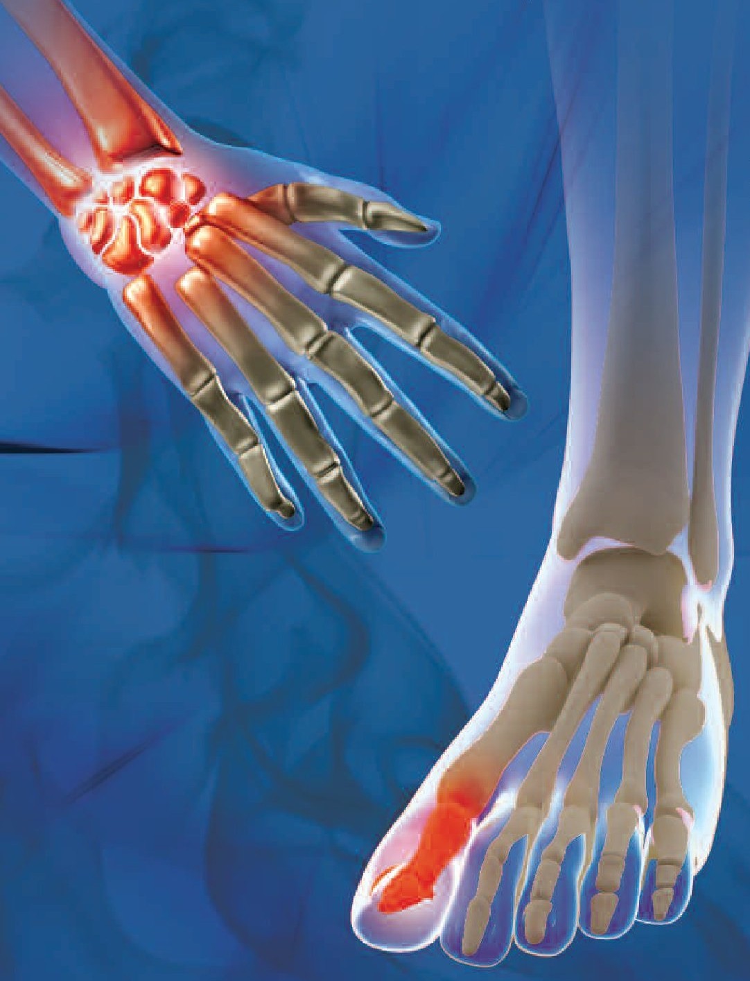 Gout - disease Of Kings