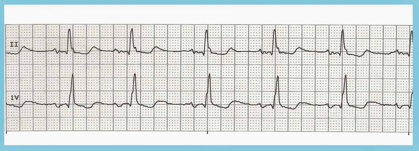 Various First Degree Heart Blocks