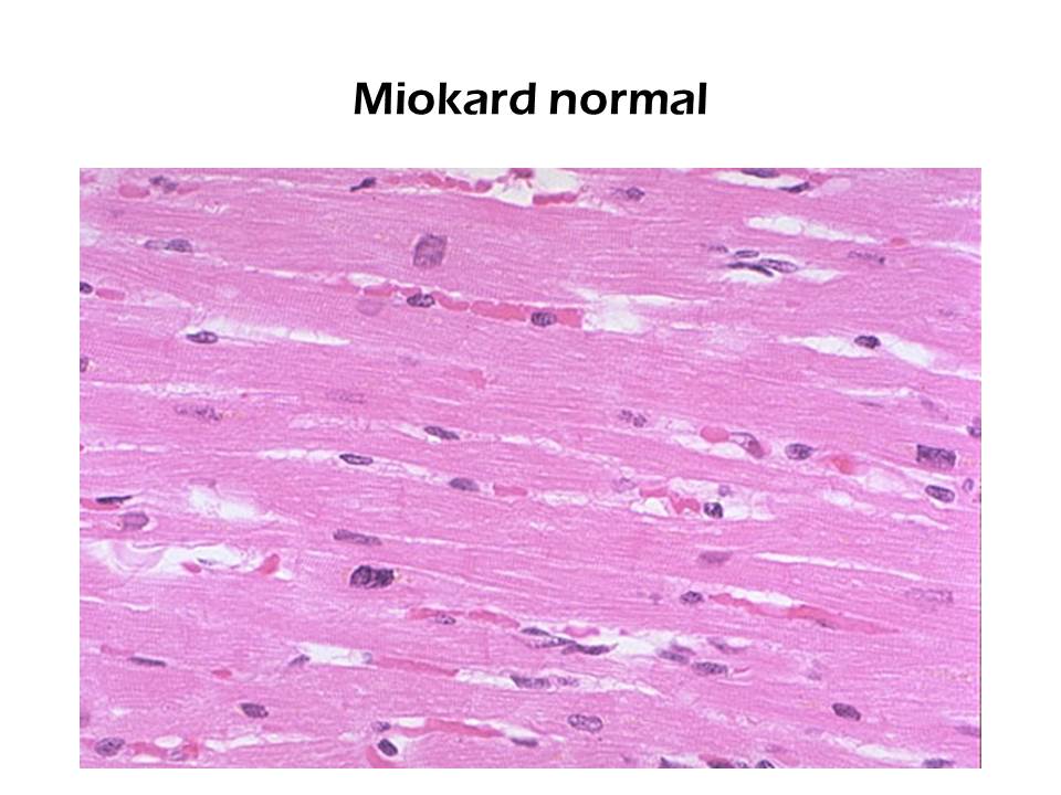 Reza Aditya Digambiro: MIOKARD INFARK