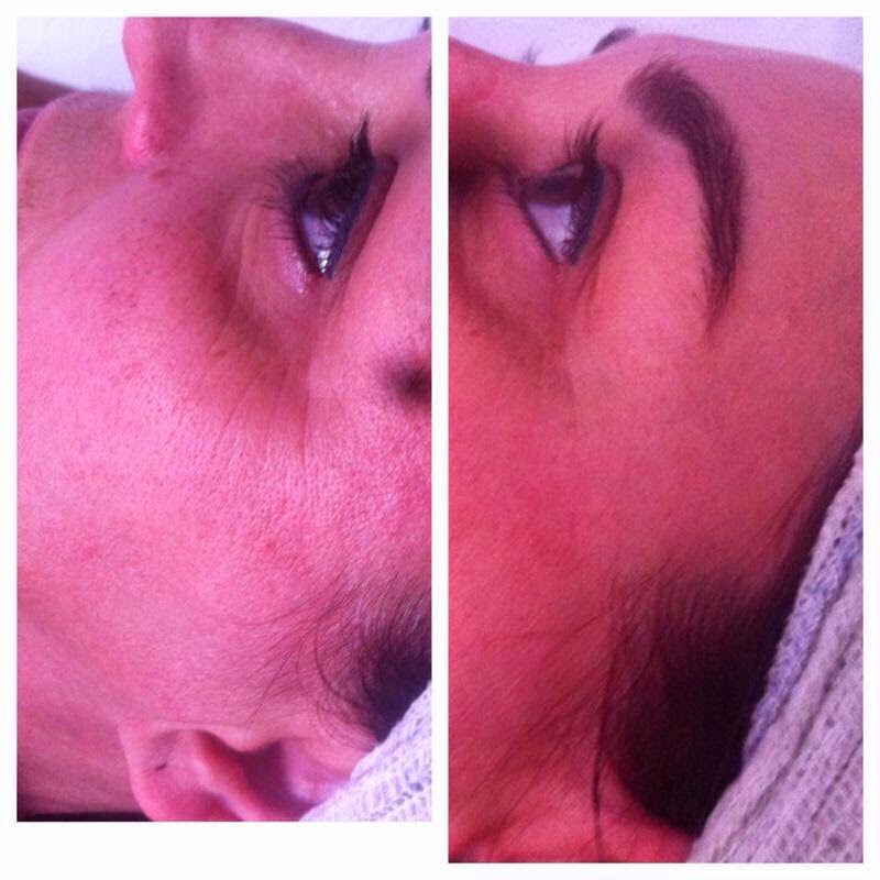 Clinica de Estética Lili Casado: Radiofrequencia