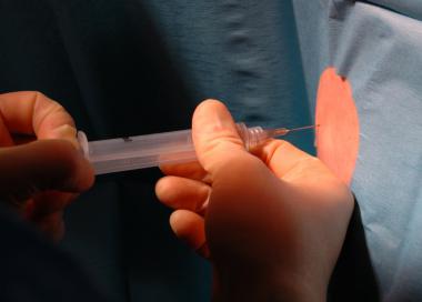 Dr. Saif ALaa ALqaisy: lung thoracentesis puncture site and technique