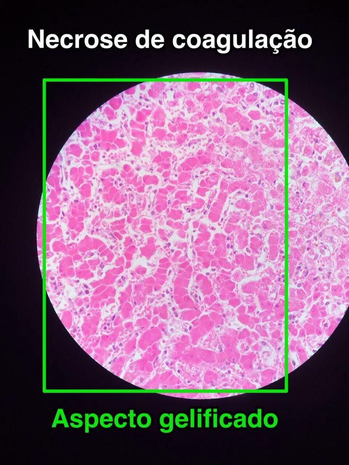 HISTOLOGIA90: TIPOS DE NECROSE