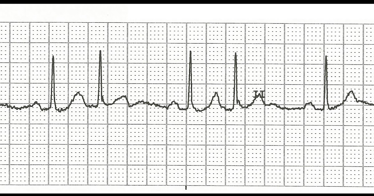Float Nurse: EKG Rhythm Strip Quiz 121