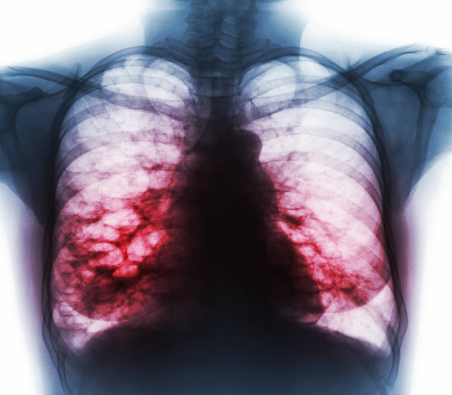 What Is Bronchiectasis? - Teroes