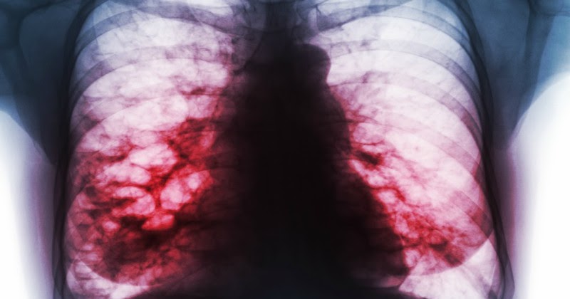 What Is Bronchiectasis? - Teroes