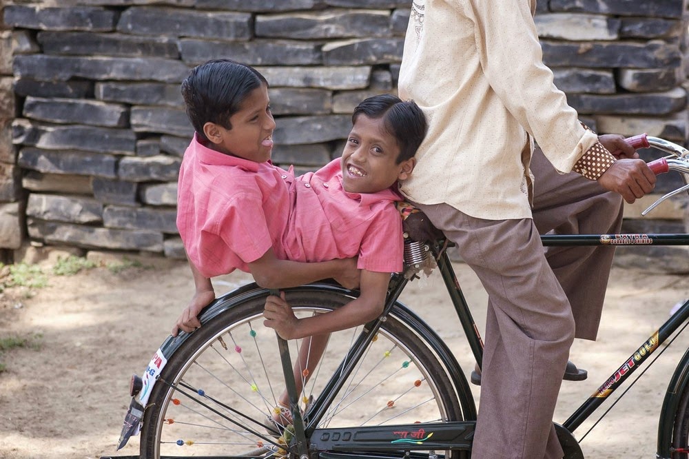 Top du Monde: Jumeaux siamois Qui Sont adoré en Inde