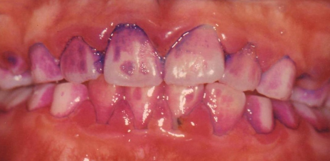 Placa Dental; Biofilm Dental; Placa Bacteriana