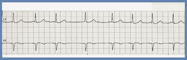Practice EKG Rhythm Strips 215