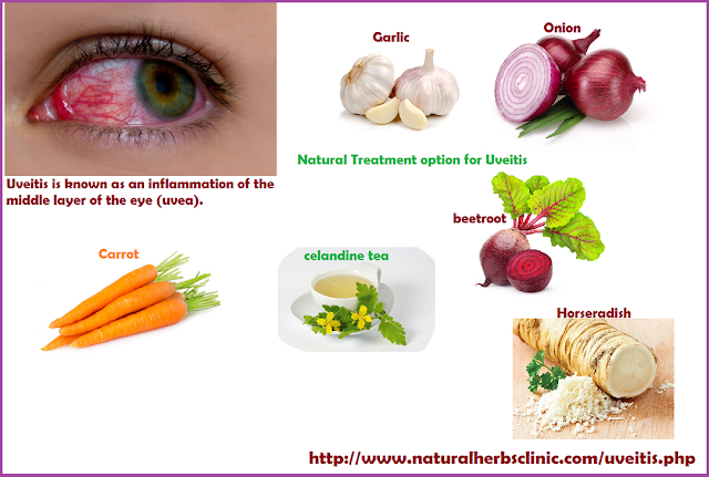 Uveitis Causes Symptoms And Treatment