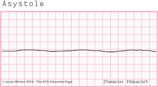 ECG Educator Blog : Asystole