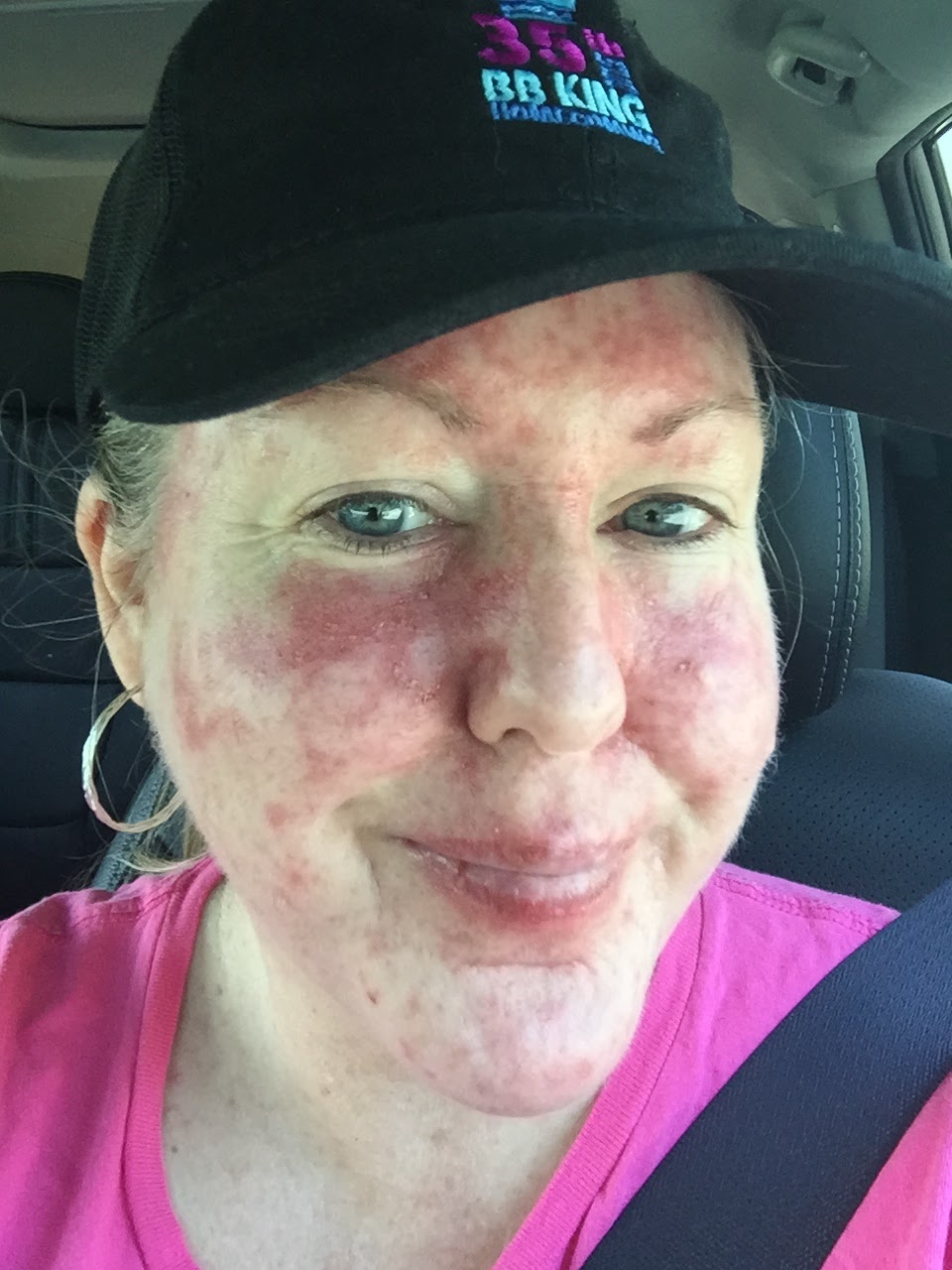 My Journey Through Topical Chemotherapy - Fluorouracil 5% Cream and ...