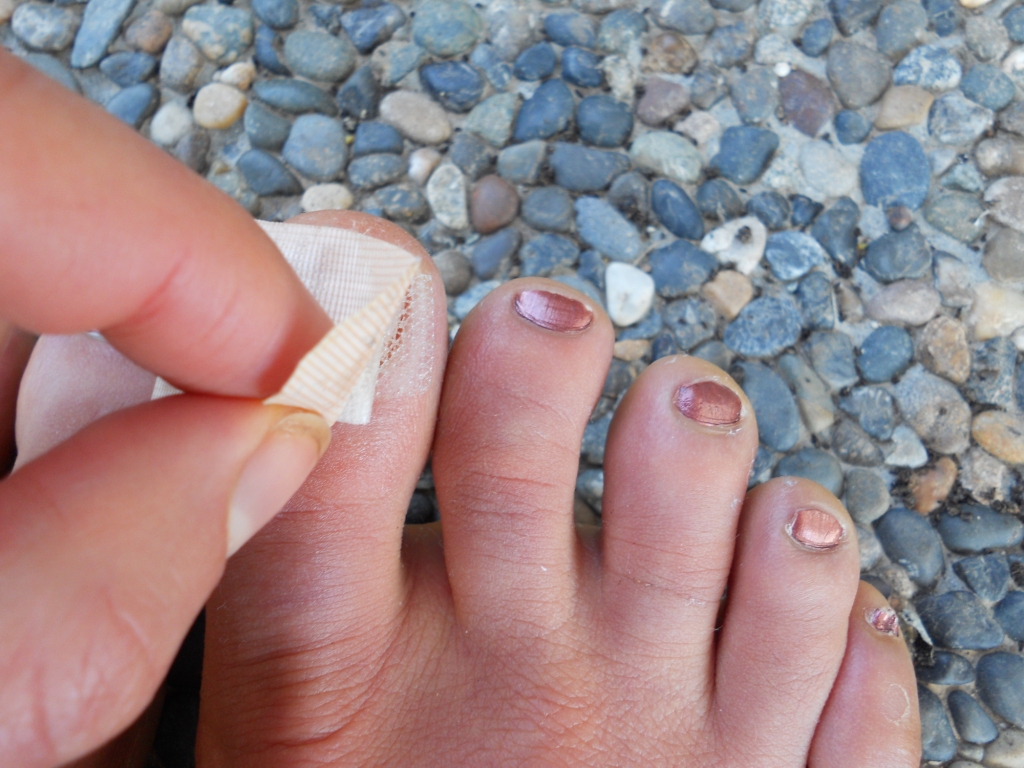 Snacking Squirrel: When Toenails Fall Off