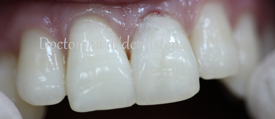 My Dental Diary: Class V restoration - Operative