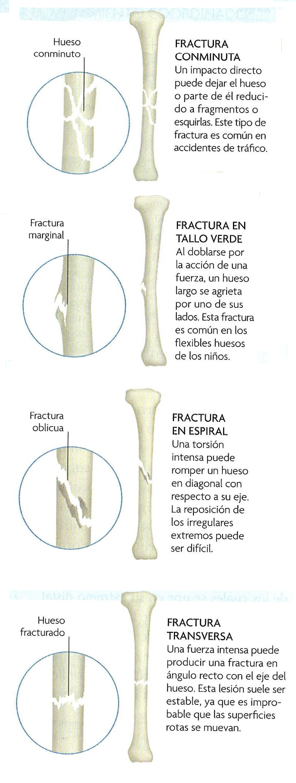 Fracturas Oseas | Reparacion Ósea