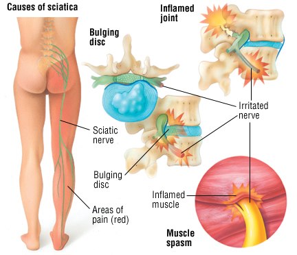 Melakukan rawatan Sciatica ~ akufisio.blogspot