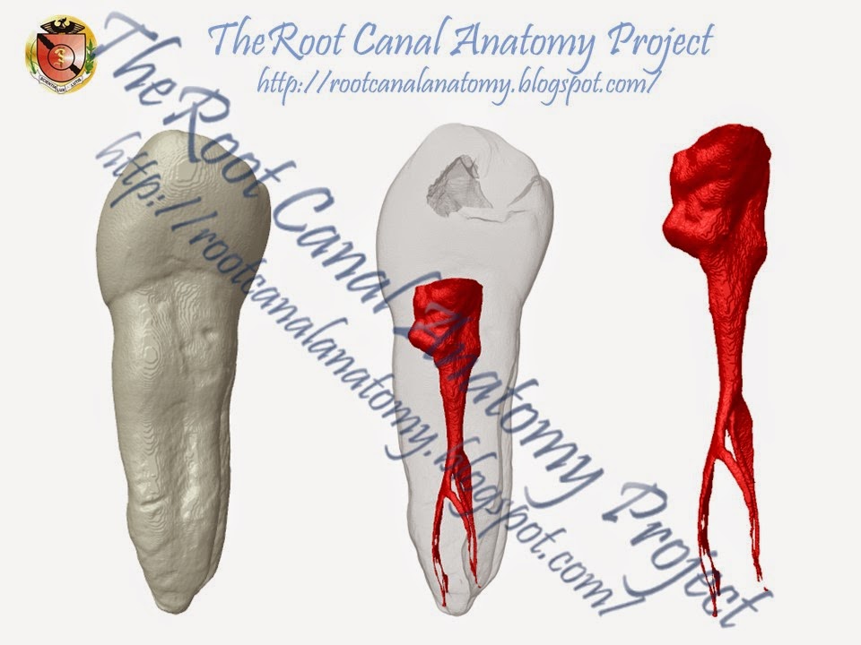 The Root Canal Anatomy Project: C-Shaped Mandibular First Premolar