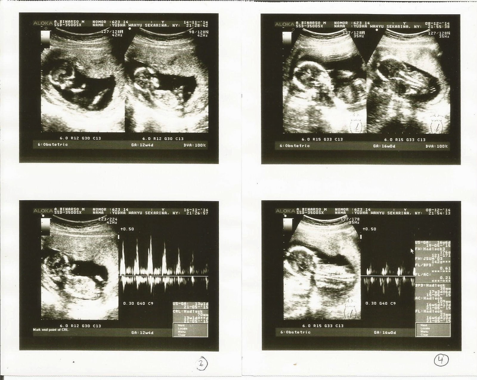 myfamily..mylife..mymiracle..myjourney: Kehamilan Kandungan 12 minggu ...