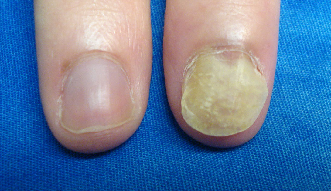VIRTUAL GRAND ROUNDS IN DERMATOLOGY 2.0: Single Nail Dystrophy