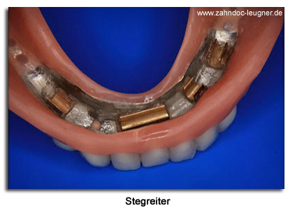 Zahnarzt Bochum Herne: Implantate, Implantation Bochum informiert: Die ...