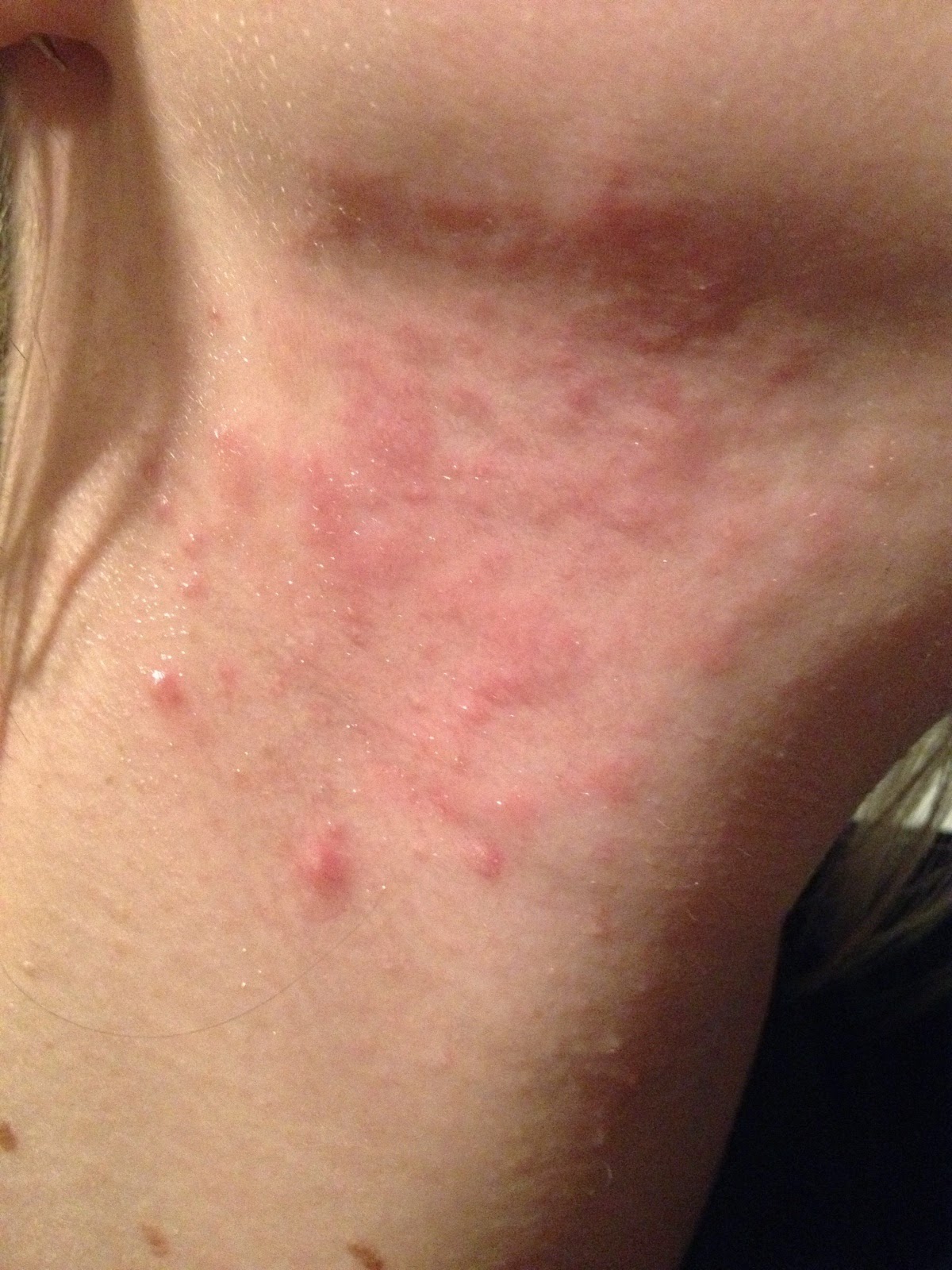 Mild Dermatitis Face