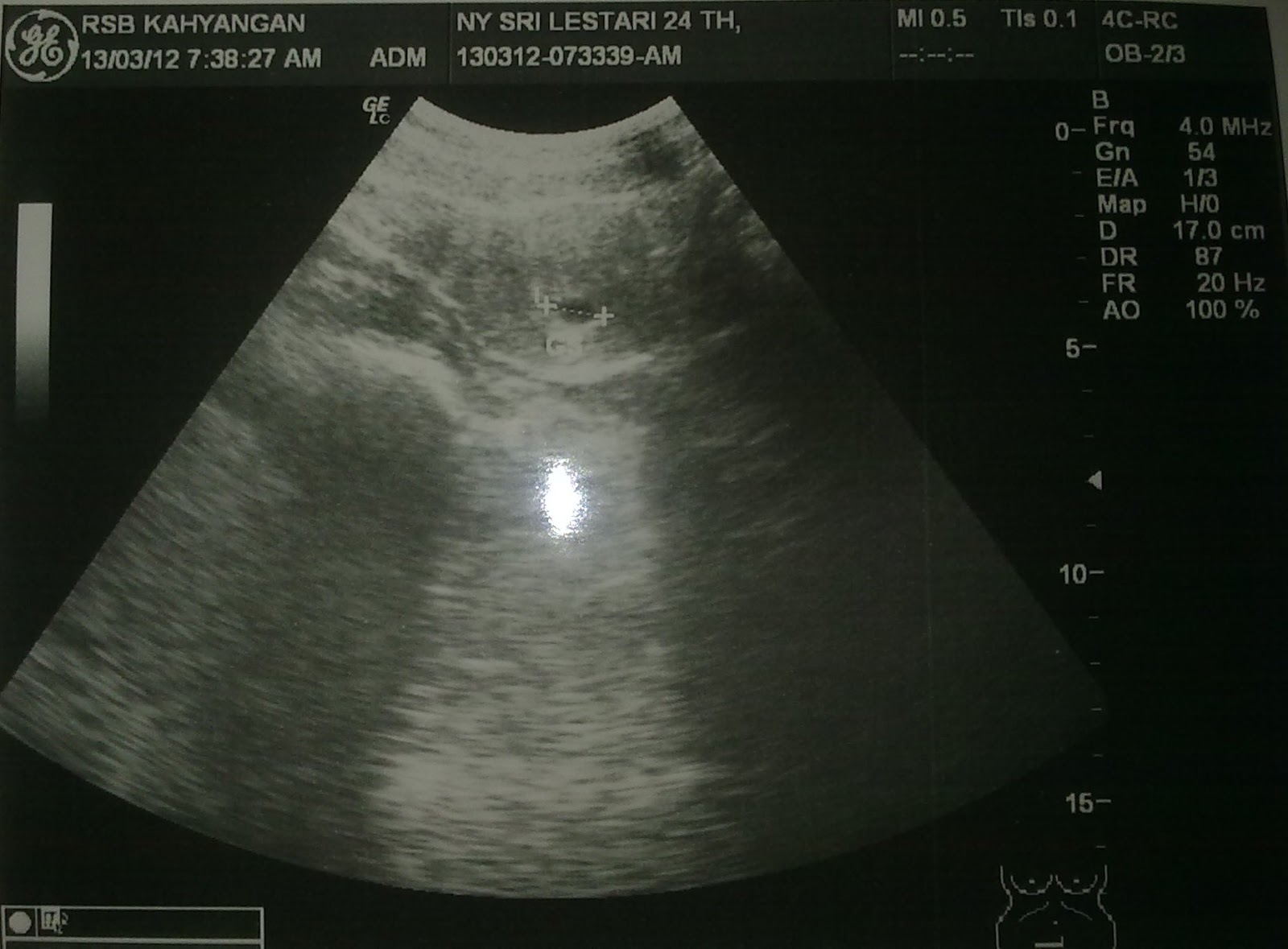 Ketahui Tanda Awal Kehamilan | Kebidanan.id