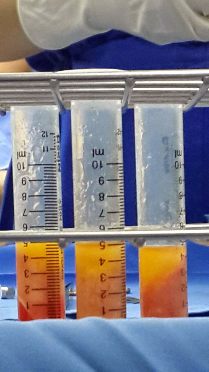 Bangkok Aesthetic Surgery Center: Fat Injection To Full Face