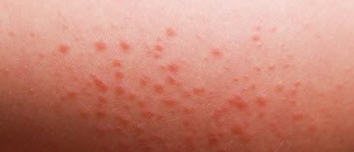 Pictures Of Rashes And Skin Rashes Photos SKIN 4 CARES pictures-of-rashes-and-skin-rashes-photos-skin-4-cares