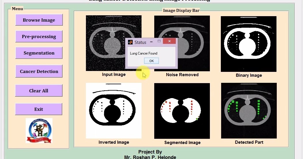 Lung Cancer Detection Using Image Processing Matlab Project Code ~ Matlab Project Codes