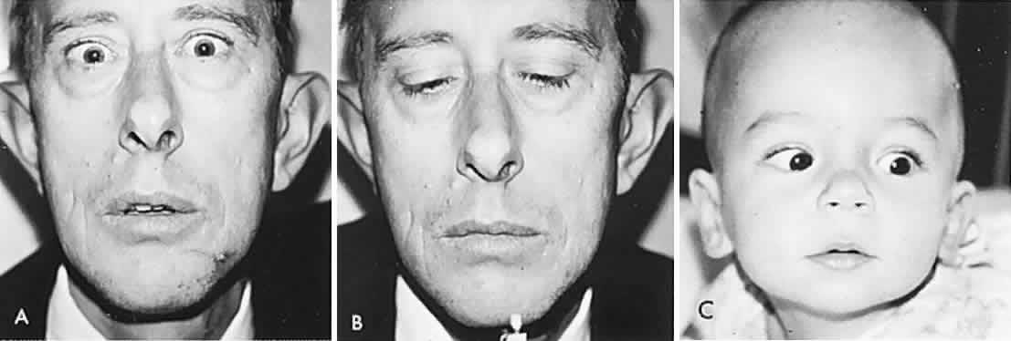 Clinical Neurology: Collier Sign