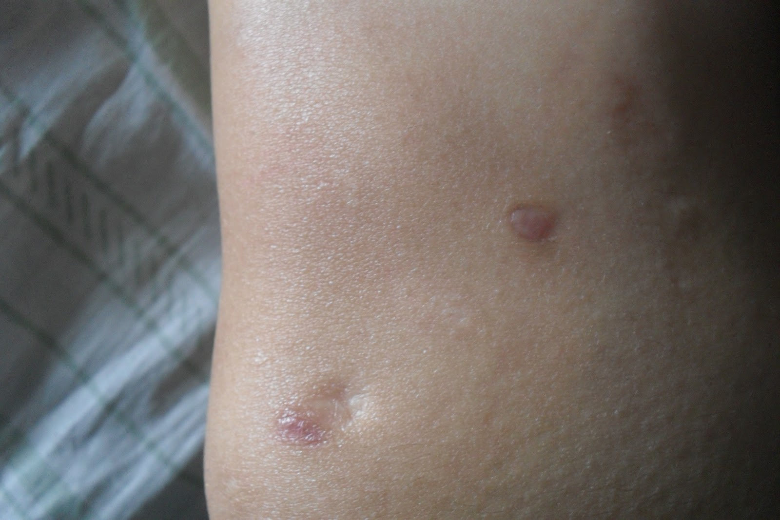 Lava Bean: Help! Scars and Boils and Rosehip oil.