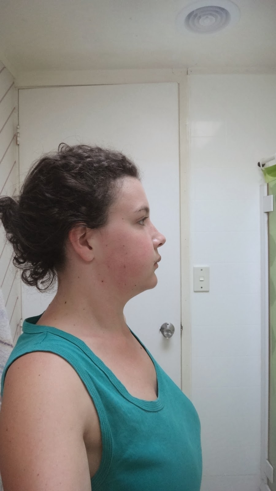 Kelsie's Jaw Surgery: Day 8: The Lopsided Face