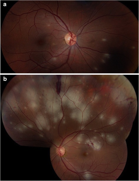 Multiple Sclerosis Research: Visual loss due to acute retinal necrosis ...