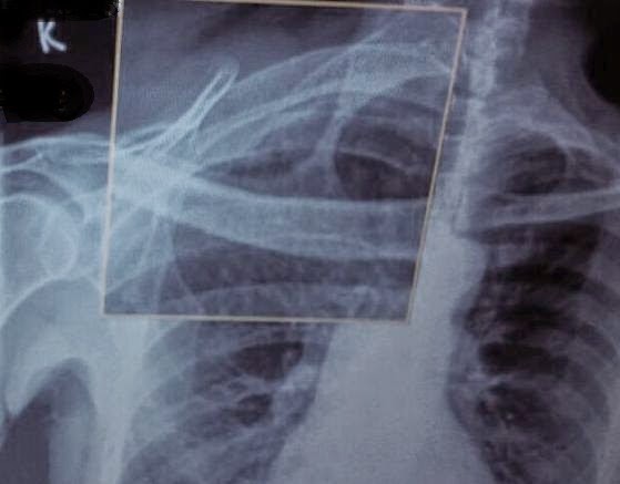 Companion Shadows-CXR - Sumer's Radiology Blog