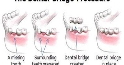 Panoramic X-ray: Dental Bridges