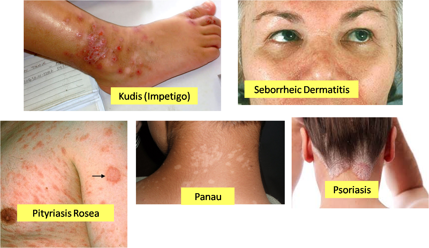 Punca Penyakit Kurap Dan Cara Merawatnya | VITAMIN UMMI ZARA - PAKAR ...