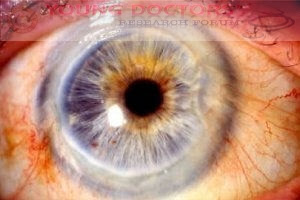 Photos For Arcus Senilis ~ YOUNG DOCTORS' RESEARCH FORUM