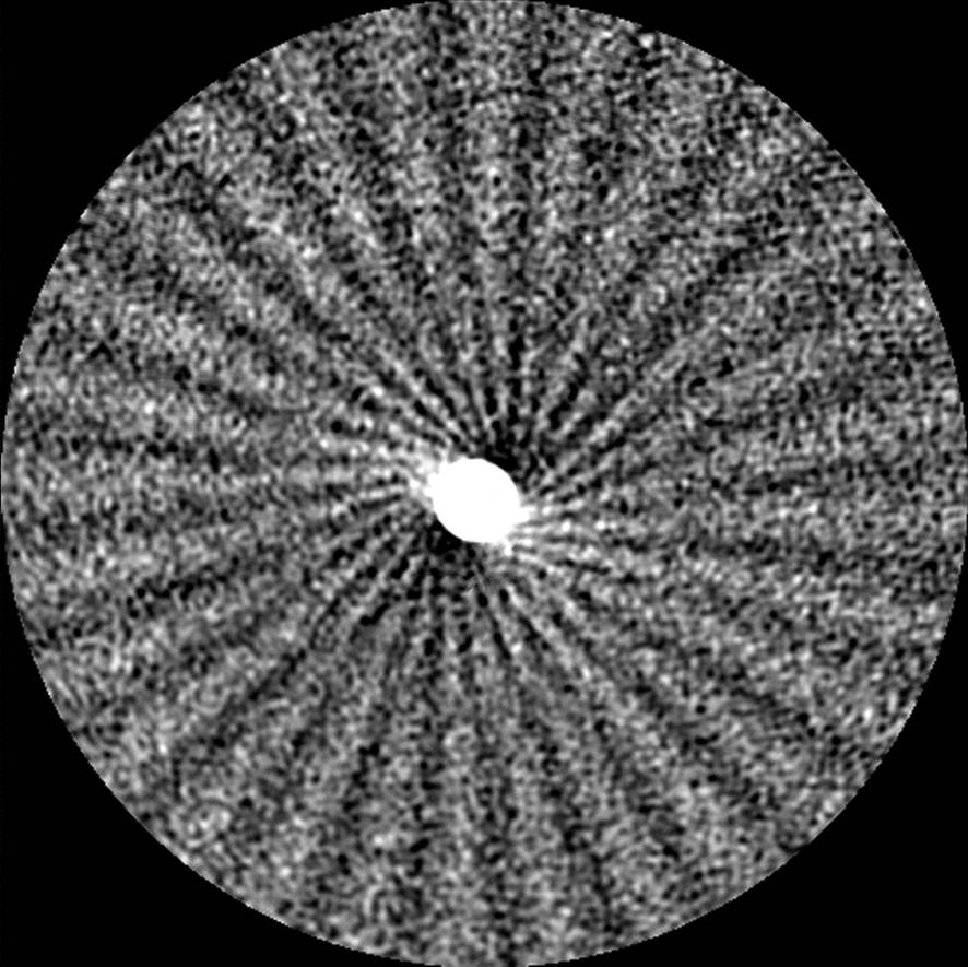 Abc Radiology Blog Computed Tomography Artifacts
