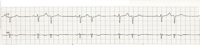 EKG Rhythm Strips 59