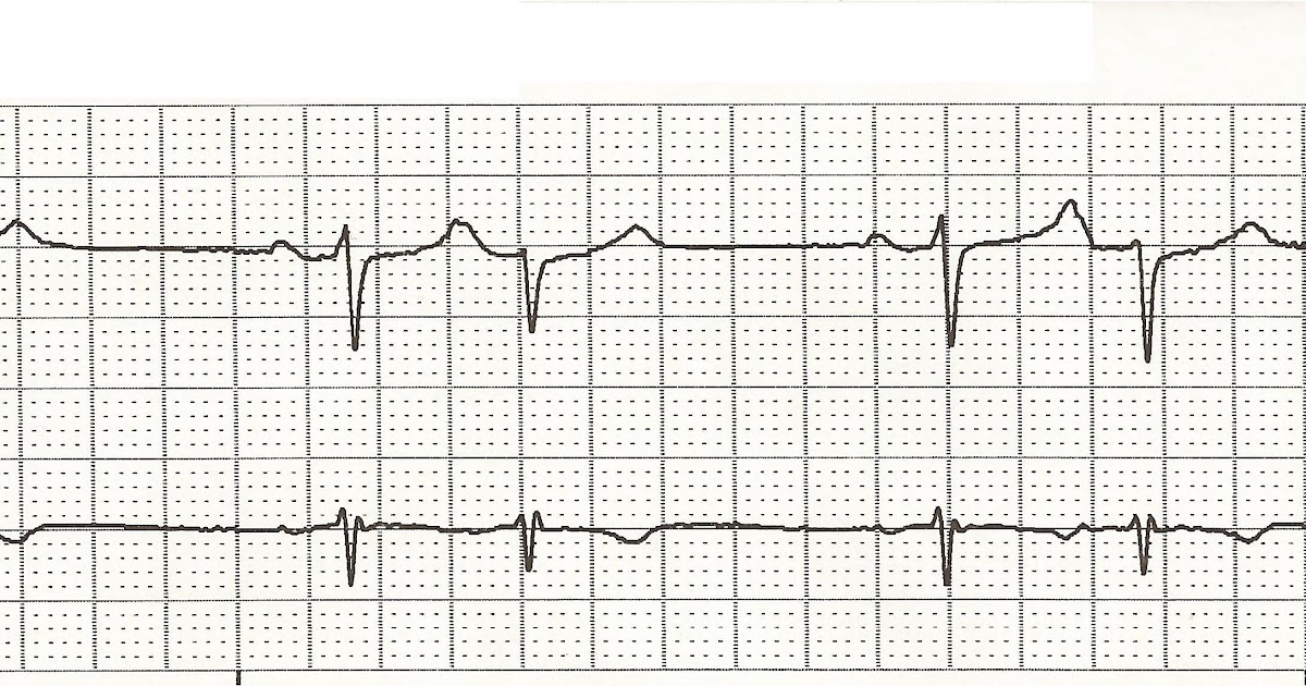 EKG Rhythm Strips 59