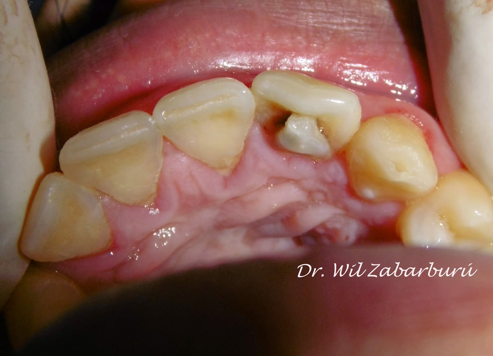 Cuspide Dental Definicion at Max Wroblewski blog