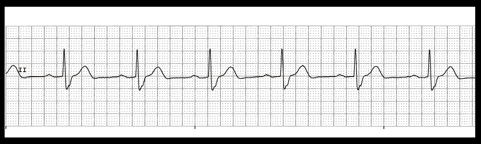 Float Nurse: Practice EKG Strips 394