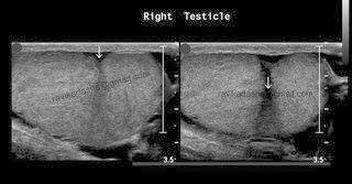 Bilobed Testes-USG - Sumer's Radiology Blog