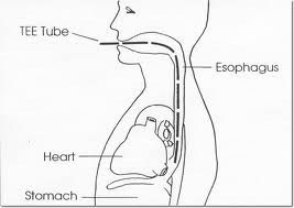 COCHIN CARDIAC CLUB: TRANSESOPHAGEAL ECHOCARDIOGRAPHY(TEE)