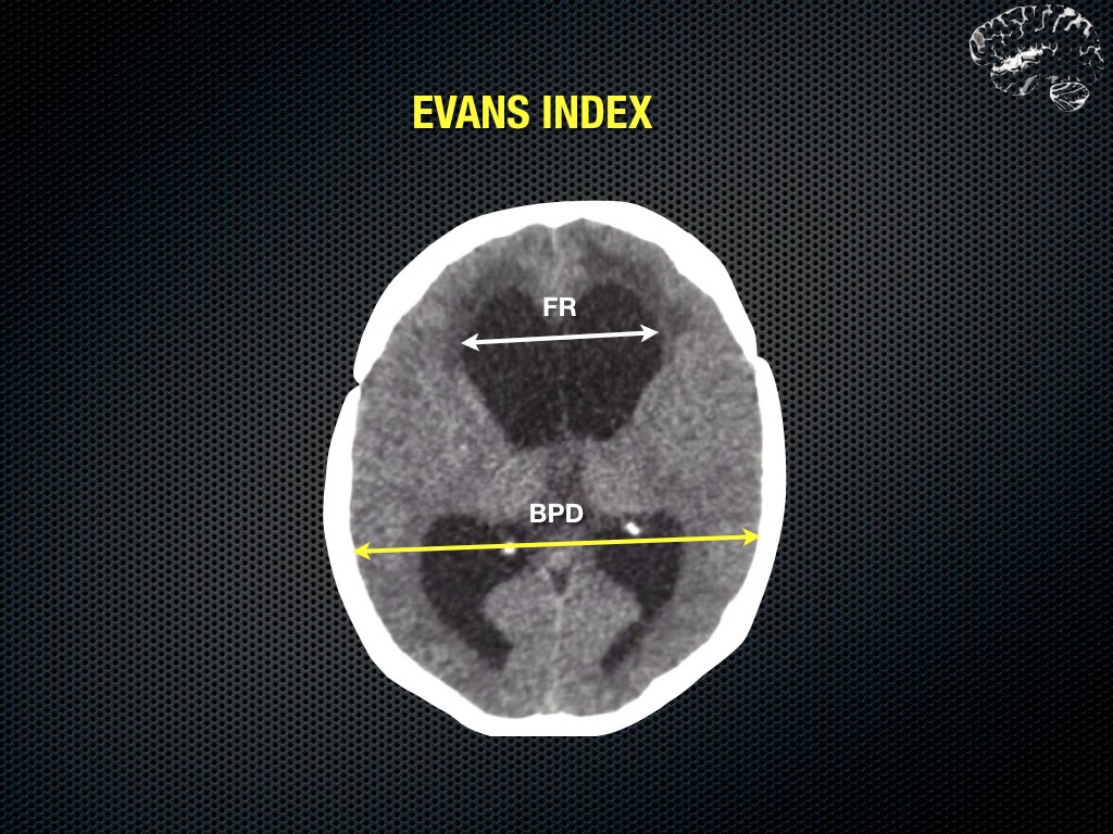 NEUROINTENSIVISMO: Hidrocefalia Pós Traumatismo Cranioencefálico Grave