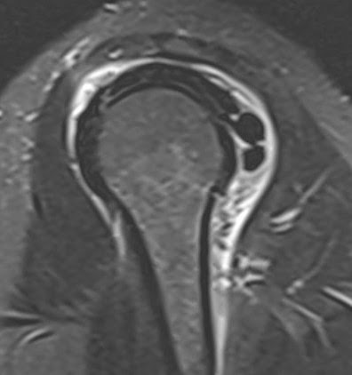 RADIODIAGNOSIS - IMAGE COLLECTION: MILWAUKEE SHOULDER