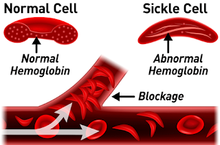 Sickle Cell Diseases