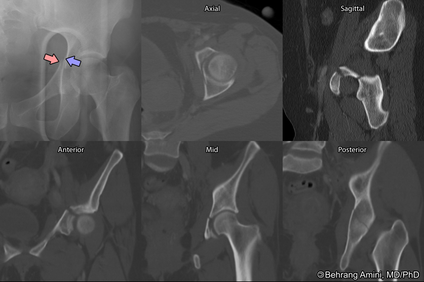 Roentgen Ray Reader: Transverse Acetabular Fractures