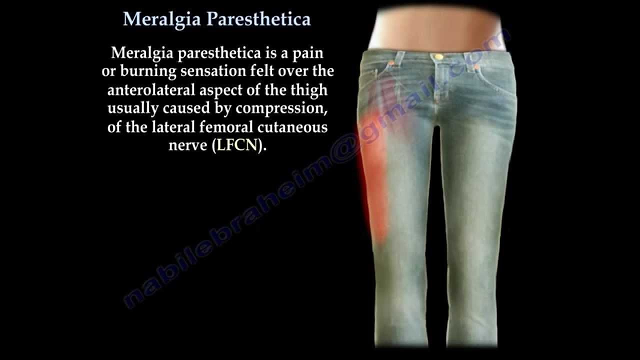 Meralgia paraesthetica