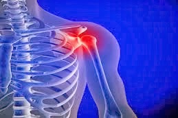 Primeros Auxilios: Dislocacion