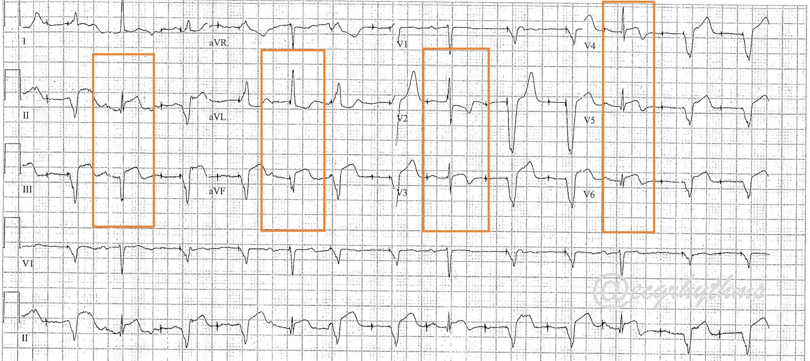 ECG Rhythms: Inferior Wall ST Elevation Myocardial Infarction in a ...